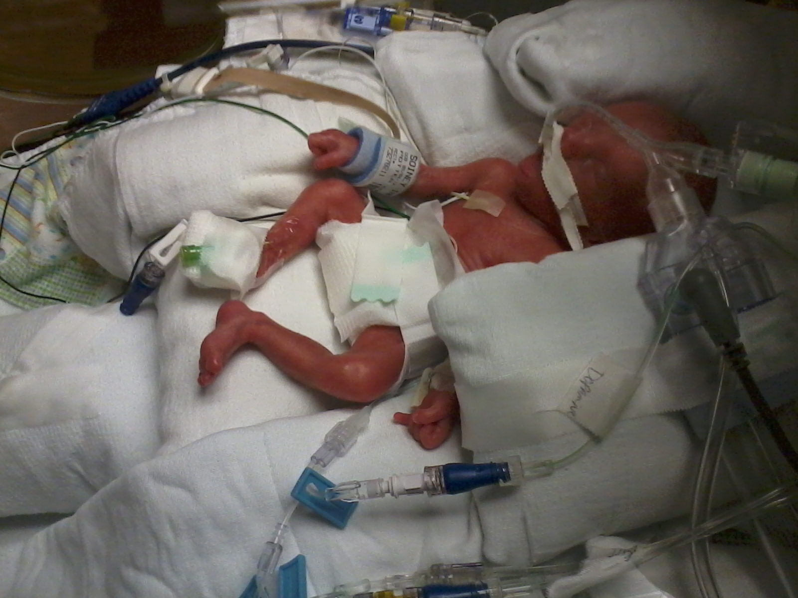 An Emergency C-Section and a Premature Birth - Shann Eva's Blog